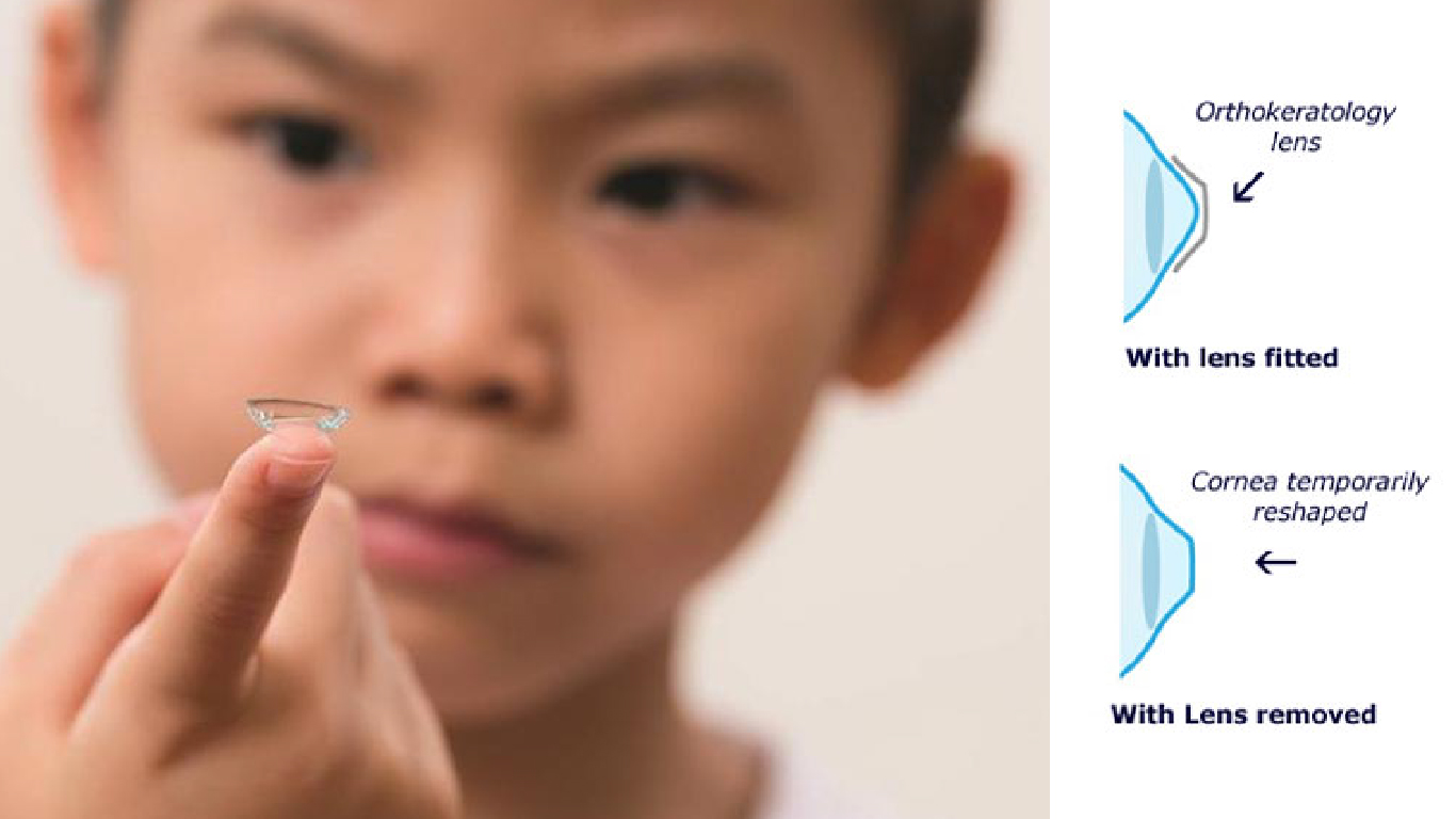 3 Research Proven Myopia Control Treatments Parents Should Know - Rx ...